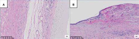 Pathological Morphology And Stratification Of Ptis A Ptism Fibrosis
