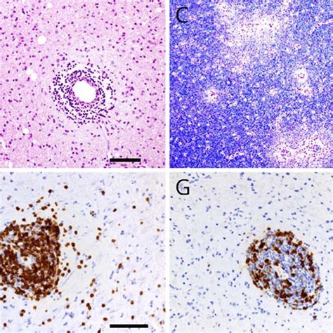 Pdf Anti Mog Encephalitis Mimicking Small Vessel Cns Vasculitis