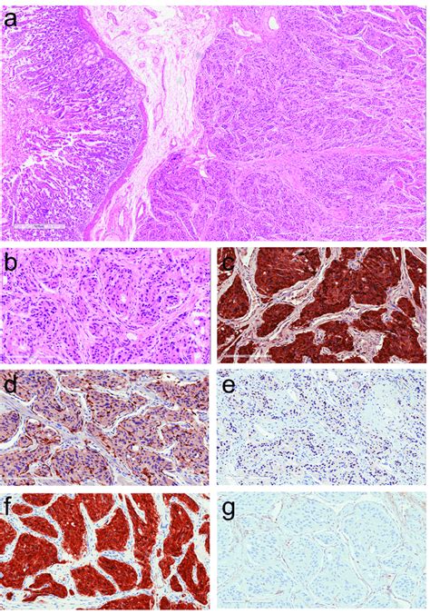 Histology And Immunoprofile Of A Duodenal Succinate Dehydrogenase Download Scientific Diagram