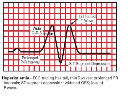 Hyperkalemia Ecg Strip