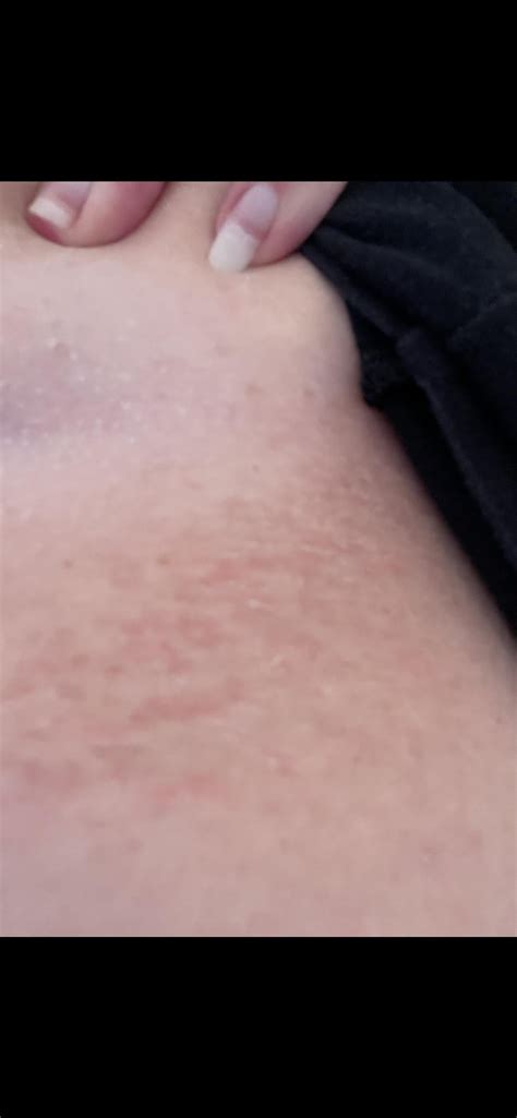 Is This Yeast Or Fungus Or Dermititis Rcandida