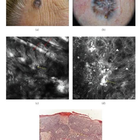 Forehead Of A 75 Year Old Woman A Bluish Ulcerated Nodule A The Download Scientific