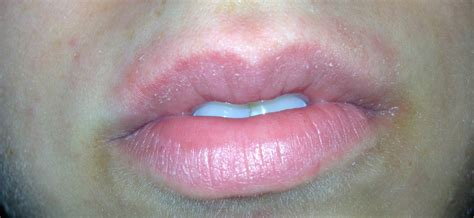 Eos Lip Balm Allergic Reaction