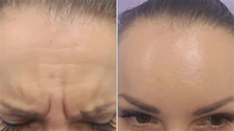 Botox 400лв в три зони чело гневна бръчка и бръчки тип”пачи крак” или две зони 300лв чело и
