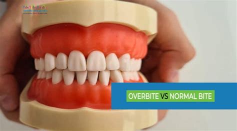 Overbite Vs Normal Bite Differences Causes And Treatment