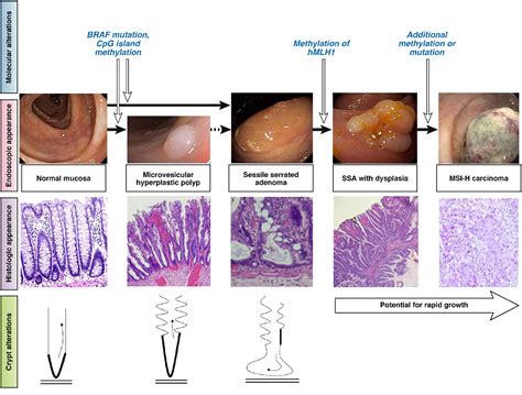 Sessile Polyp
