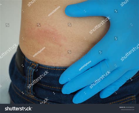 Heat Rash Red Rash On Womans Stock Photo Shutterstock