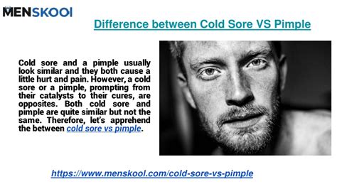 Ppt Difference Between Cold Sore Vs Pimple Powerpoint Presentation Free Download Id 11429603