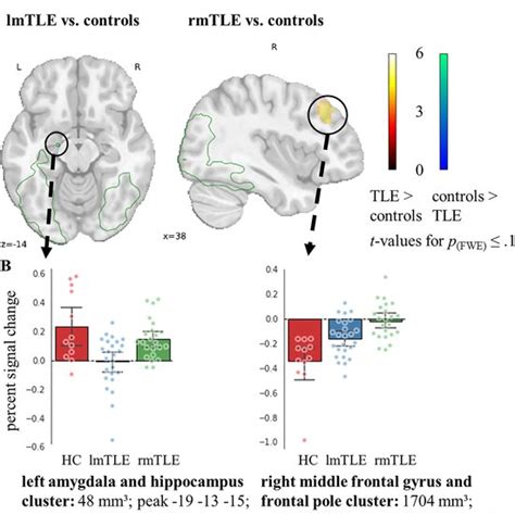 Fmri Activation Encoding Vs Baseline Across Group Fmri Activation Of