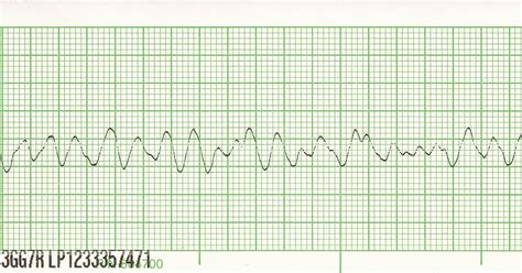 ACLS Review Pulseless VF VT Part
