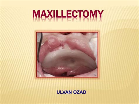 Maxillectomy Ppt