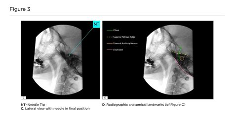 How I Do It Gasserian Ganglion Block For Trigeminal Neuralgia How I Do It Gasserian Ganglion Block For Trigeminal Neuralgia