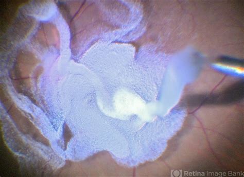 Intraoperative Triamcinolone Staining To Visualize Hyaloid Retina