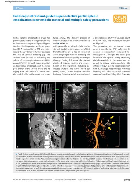 Pdf Endoscopic Ultrasound Guided Super Selective Partial Splenic Embolization New Embolic