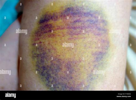 Contusion Vs Hematoma Hematoma Vs Bruise How To Tell The Difference
