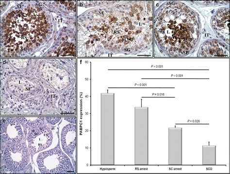 Immunoexpression Of The Pabpc1 Protein In The Noa Groups Cellular And