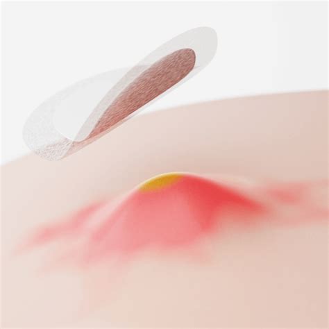 10 Powerful Reasons Why Pimple Patches Are The Best Quick Fix For Acne [say Goodbye To Breakouts