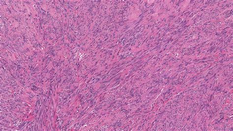 Gastrointestinal Stromal Tumour Of The Stomach Atlas Of Pathology