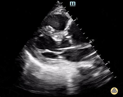 Thoracic Aortic Aneurysm Echocardiogram Thoracic Aortic Aneurysm Echocardiogram