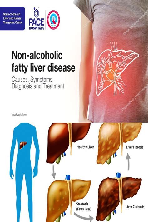 The Non Alcoholic Fatty Liver Disease Solution Artofit