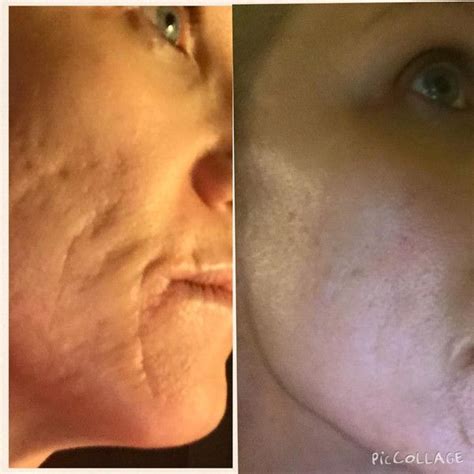 My Before And After Photos I LOVE This Organic Oil Thank You Your