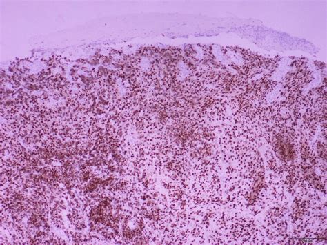 Sox10 Highlights The Nuclei Of Invasive Malignant Melanocytic Cells