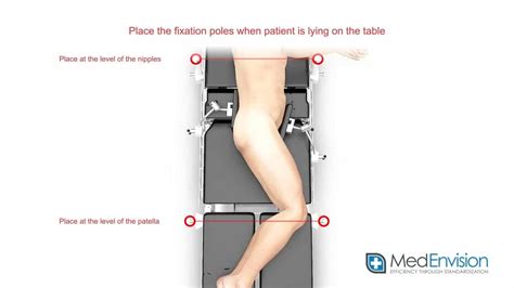 Fixation Devices The Gripper™ System