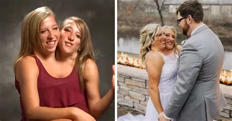 Dicephalus Conjoined Twin Abby Hensel Of “abby And Brittany” Is Married South Africa
