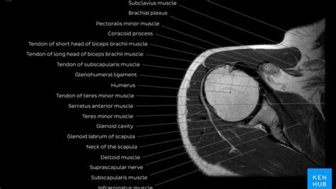 How To Read Shoulder Mri Pptx