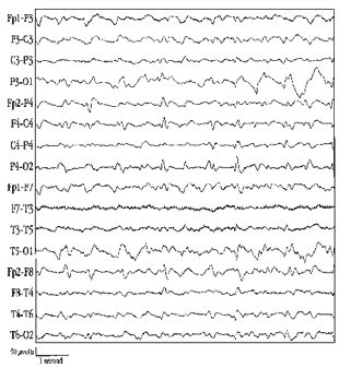 How To Read An Eeg Epilepsy Foundation