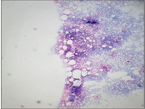 Comparative Analysis Of Detecting Cervical Lymph Node Metastasis With