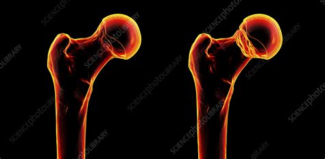 Subcapital Femur Fracture Illustration Stock Image F043 9285 Science Photo Library