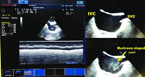 Left Side Transoesophageal Echocardiographic Image Showing The