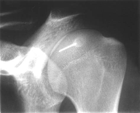 Arthrography Of The Shoulder A Simple Fluoroscopically Guided Approach For Targeting The