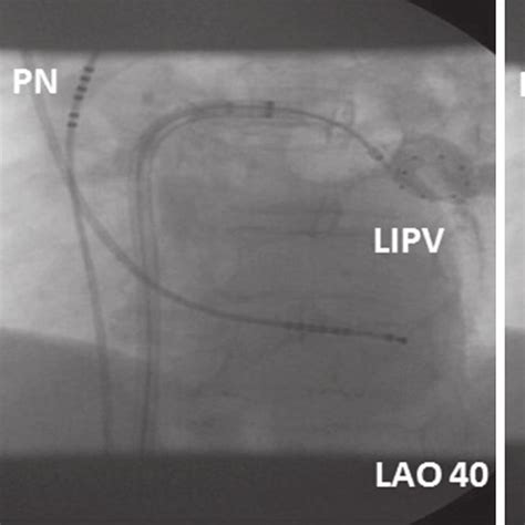 Pdf Practical Techniques In Cryoballoon Ablation How To Isolate Inferior Pulmonary Veins
