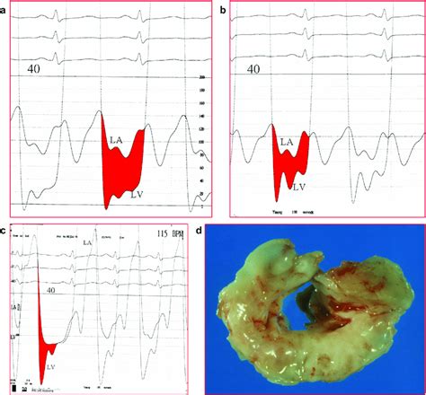 Balloon Mitral Valvuloplasty In A 32 Year Old Female With Rheumatic