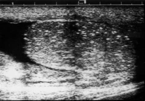 Ultrasound Image Showing Numerous Small Echogenic Foci Of Download Scientific Diagram