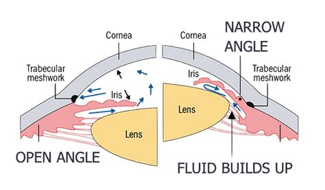 Narrow Angles Nitasha Gupta Md