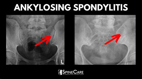How Does Ankylosing Spondylitis Affect The Spine At Christopher Pettway