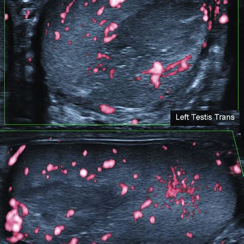 Day 5 Power Doppler Ultrasound Left Testis In Transverse Above And