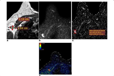 A 48 Year Old Female A T1wi Enlarged Right Axillary Lymph Node With Download Scientific Diagram