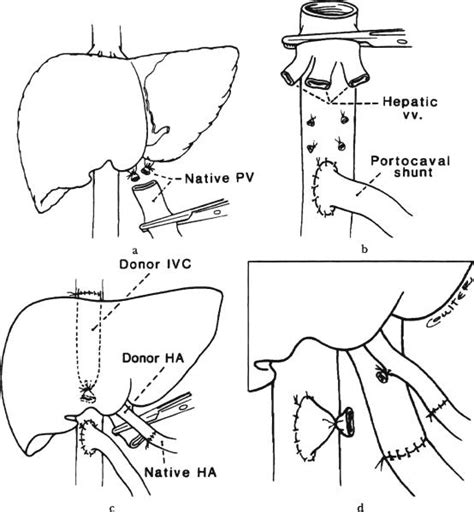 Portacaval Anastomosis Diagram