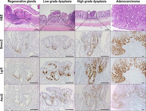 Rna In Situ Hybridization For Crypt Base Columnar Cbc Stem Cell