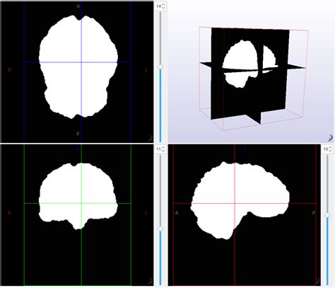 Medical Image Segmentation And Registration