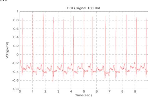 Figure 6 From Wavelet Based Qrs Detection In Ecg Using Matlab