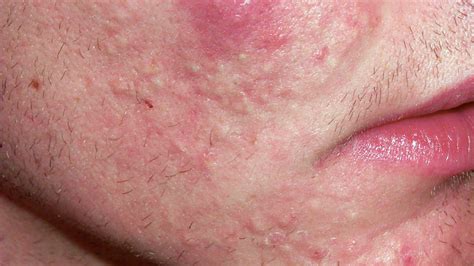 Acne Comedonal Aberta Papulopustular Infantile Acne Treated With Oral