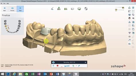 How To Split A Dental Frame Bridge In 3shape Youtube