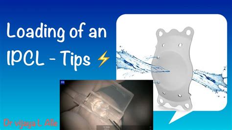 Loading Of An Ipcl Tips Dr Vijaya Youtube