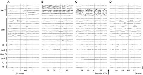Example Intracranial Eeg Recording During A Temporal Lobe Download