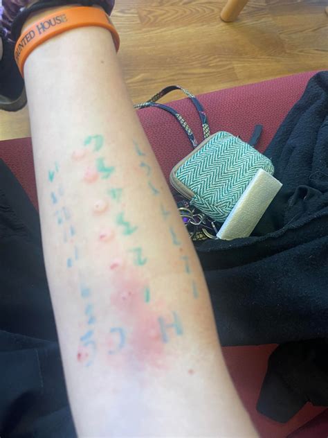 Allergy Test R Allergy